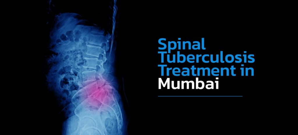 Spinal Tuberculosis Specialist in Thane